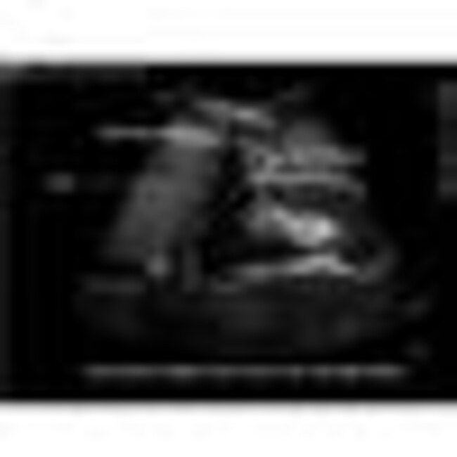 3B Scientific Blue Phantom FAST, TEE and TTE Training Model Ultrasound ...