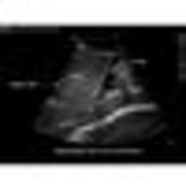 3B Scientific Blue Phantom FAST, TEE and TTE Training Model Ultrasound ...