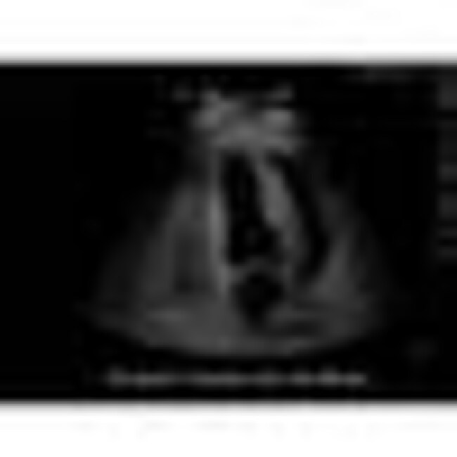 3B Scientific Blue Phantom TTE Ultrasound Training Platform Without ...