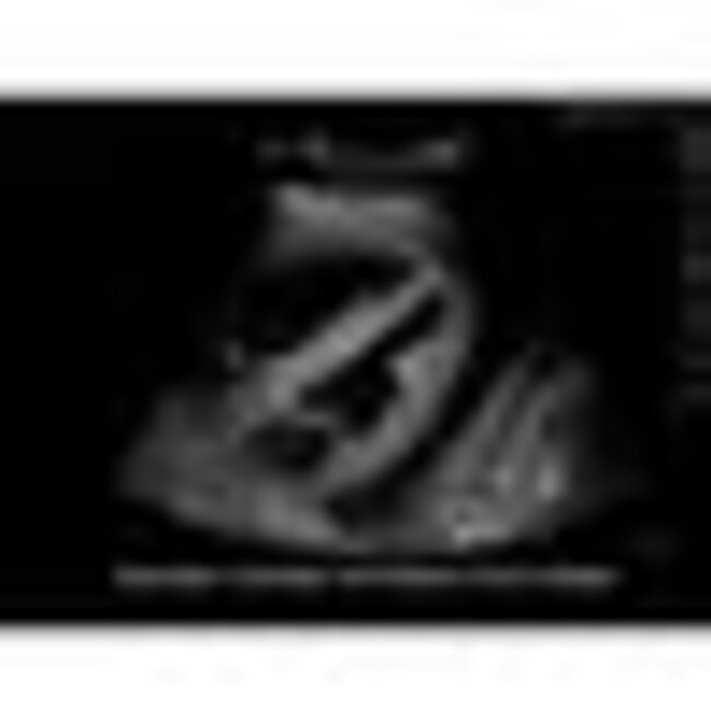 3B Scientific Blue Phantom TTE Ultrasound Training Platform Without ...