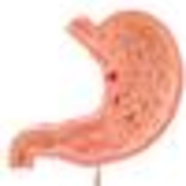 3B Scientific Human Stomach Section Model with Ulcers Human Stomach ...