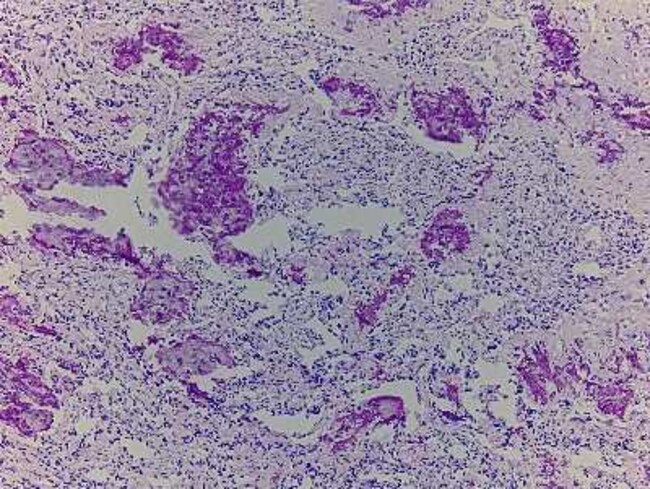 Novus Biologicals Bone Tissue Slides (Tumor)- Paraffin 5 Slides ...