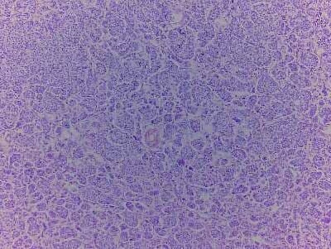 Novus Biologicals Breast Matched Tumor and Normal Tissue Slides (Tumor ...