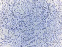 Novus Biologicals Kidney Tissue Slides (Papillary Carcinoma)- Paraffin ...