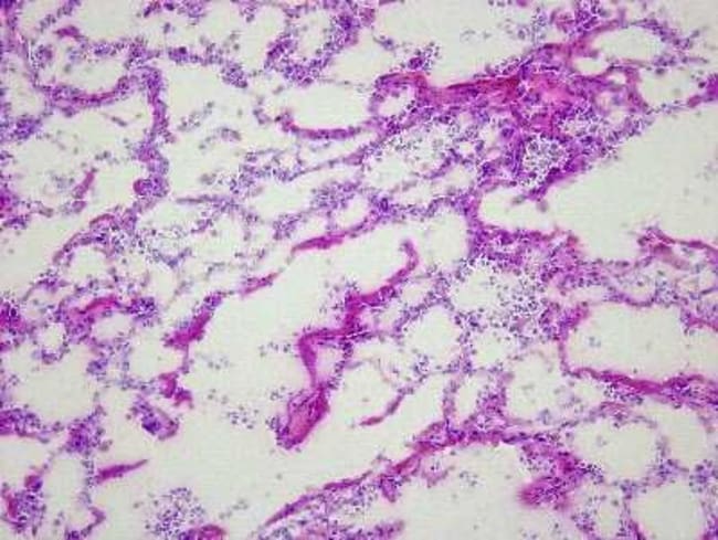 Novus Biologicals Lung Tissue Slides (Pulmonary Embolism)- Frozen 5 ...