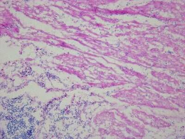 Novus Biologicals Rectum Matched Tumor and Normal Tissue Slides (Tumor ...