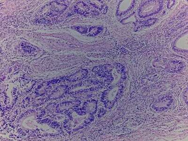 Novus Biologicals Stomach Tissue Slides (Adenocarcinoma)- Paraffin 5 ...