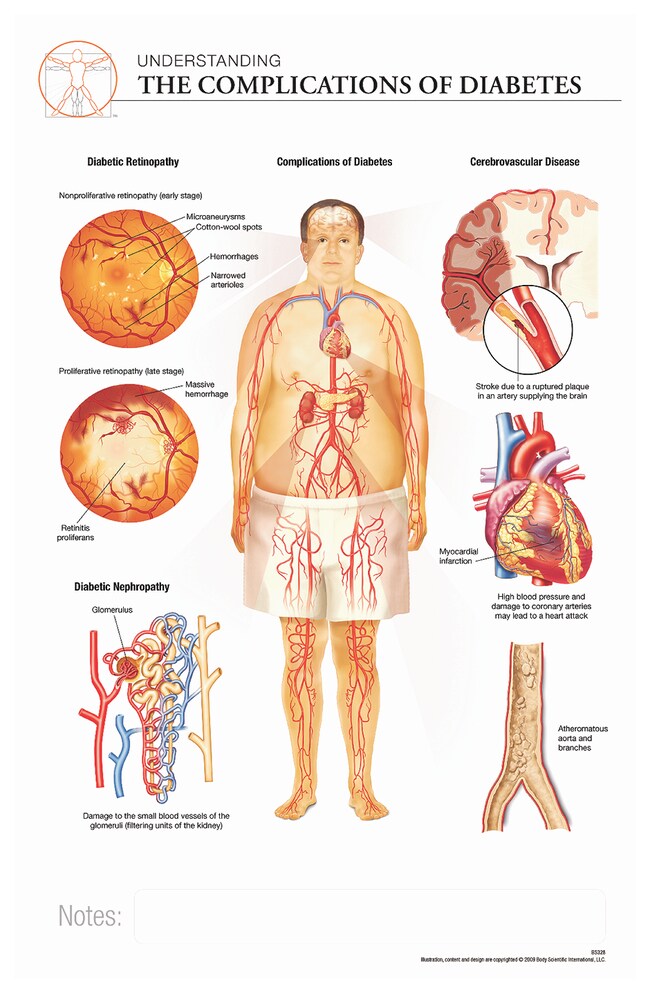 Body Scientific International Post it Complications Of Diabetes Chart 