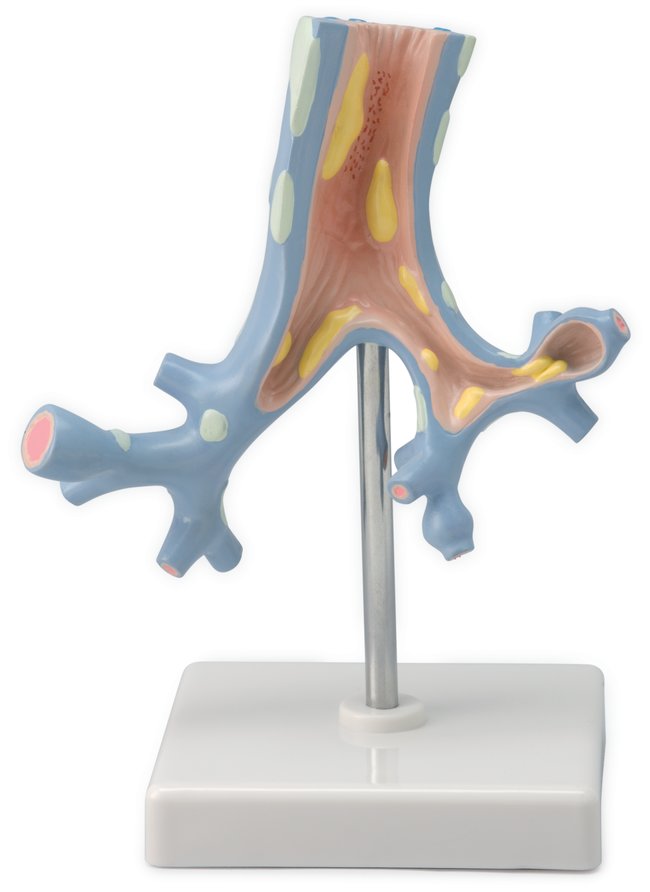 Altay Scientific Pathological Model of the Bronchi Pathological Model ...